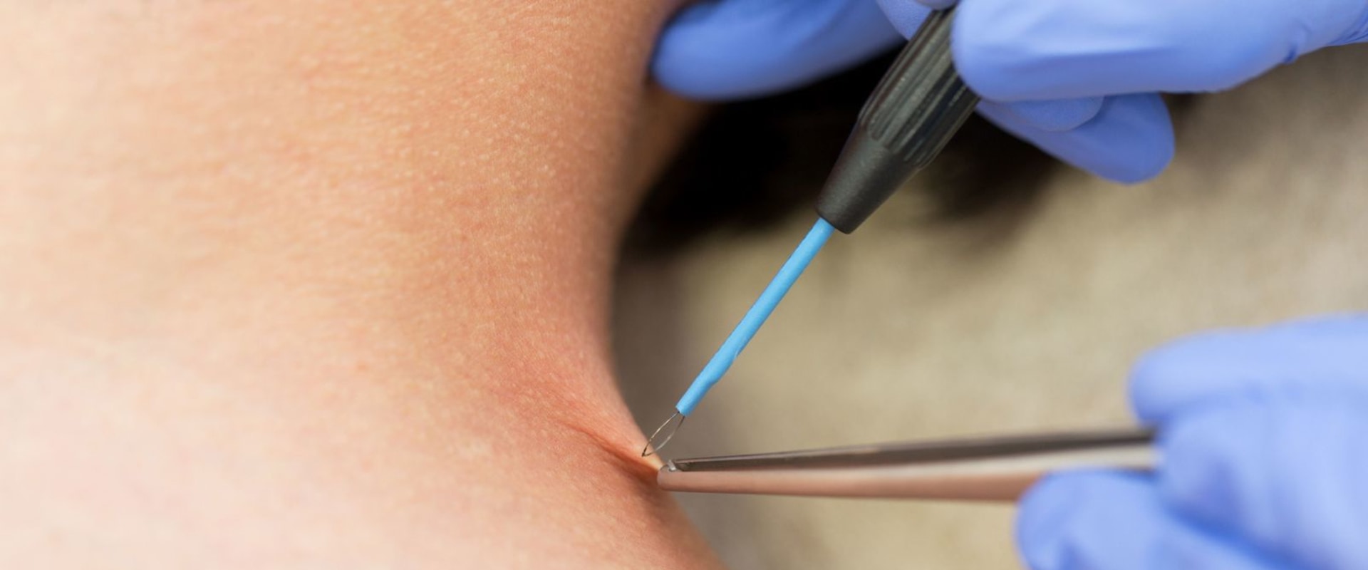 Spot the Difference Between Plantar Wart vs Corn With This Expert ...
